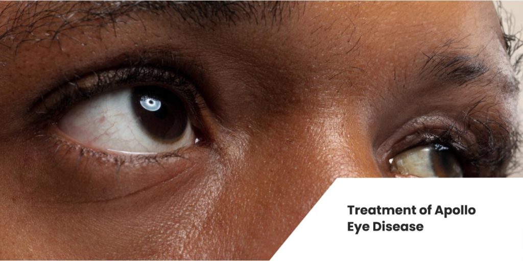 Treatment of Apollo Eye Disease - Skipper EyeQ